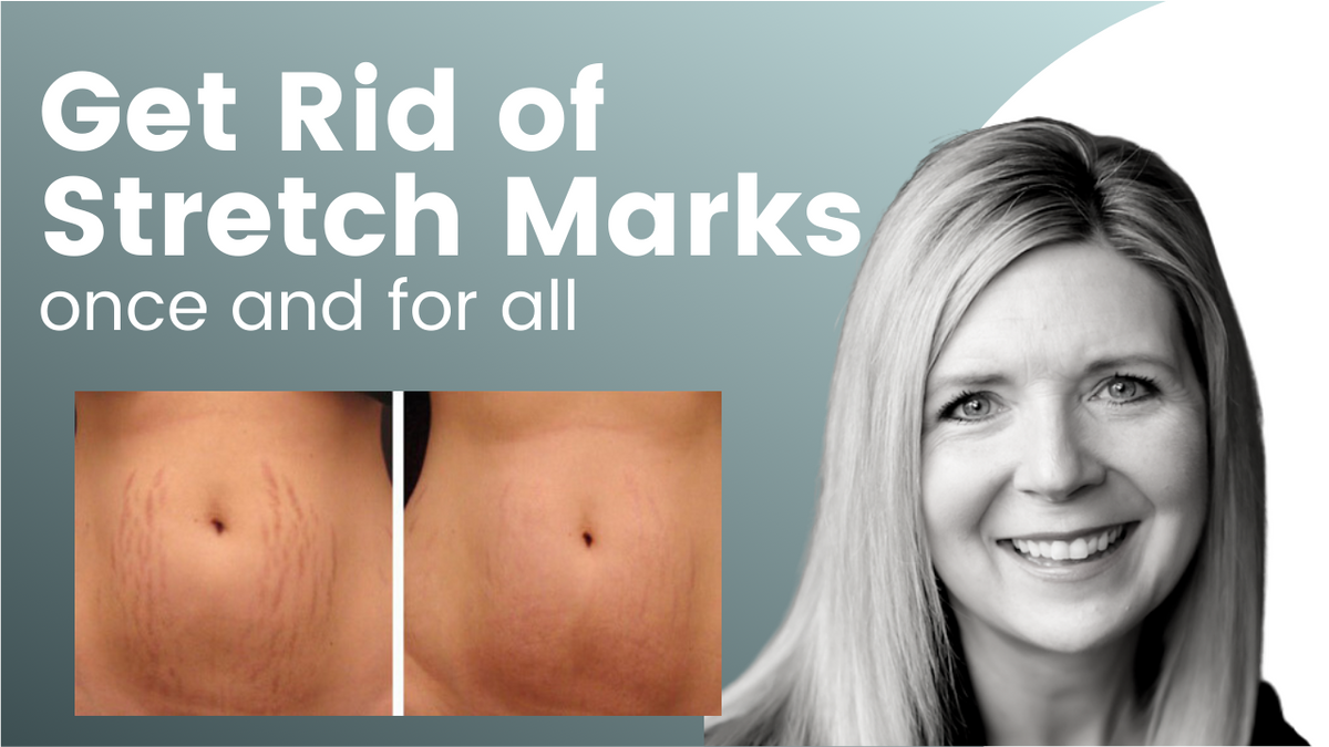 Kiss your Stretch Marks Goodbye! – Estetica Spa
