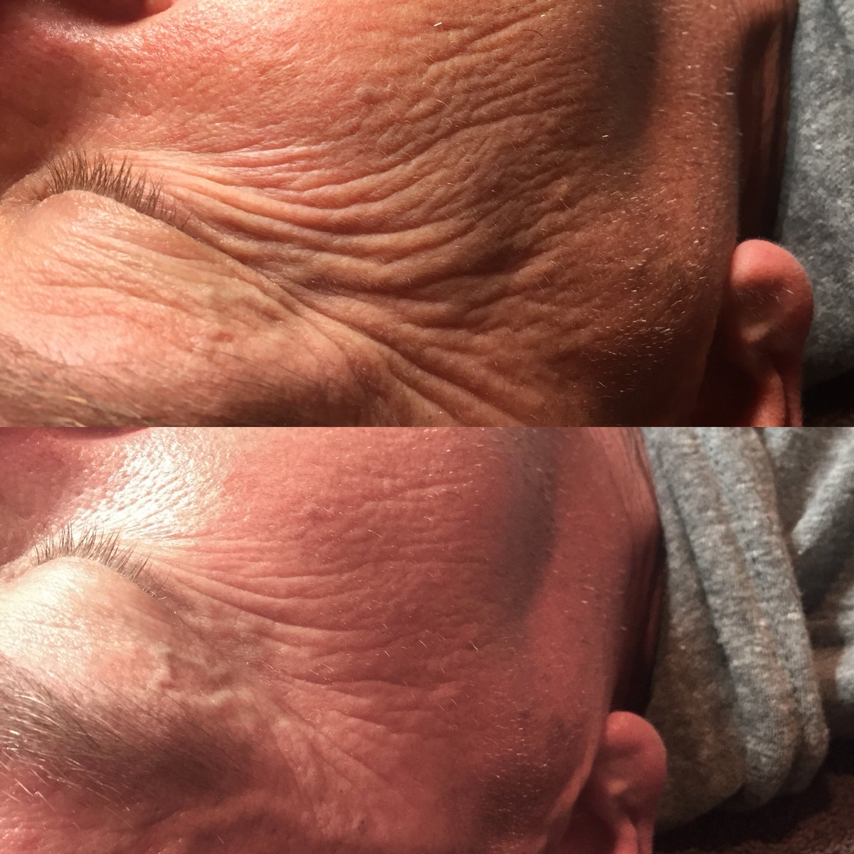 It's Like a Shop Vac for the Skin! – Estetica Spa